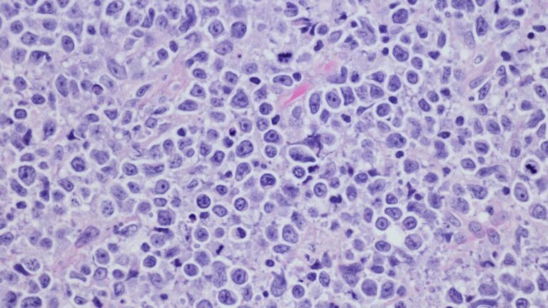 Researchers identify key B-cell lymphoma traits linked with greatest ...